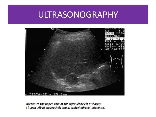 Adrenal Adenoma Radiology