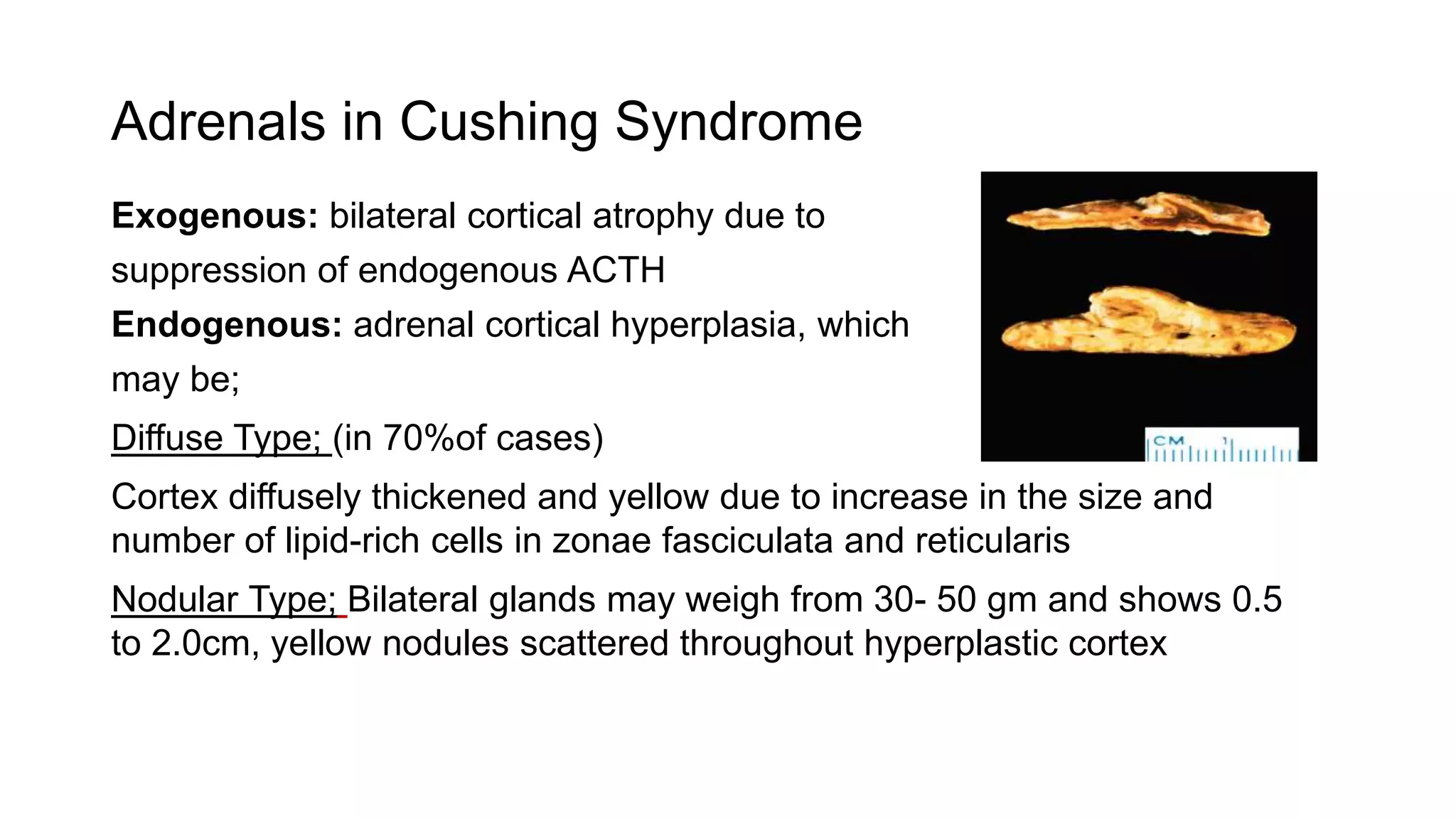 Adrenal cortical disorderspptx | PPTX