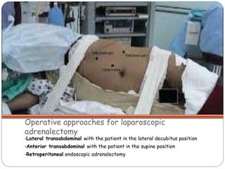 adrenalectomy.pptx