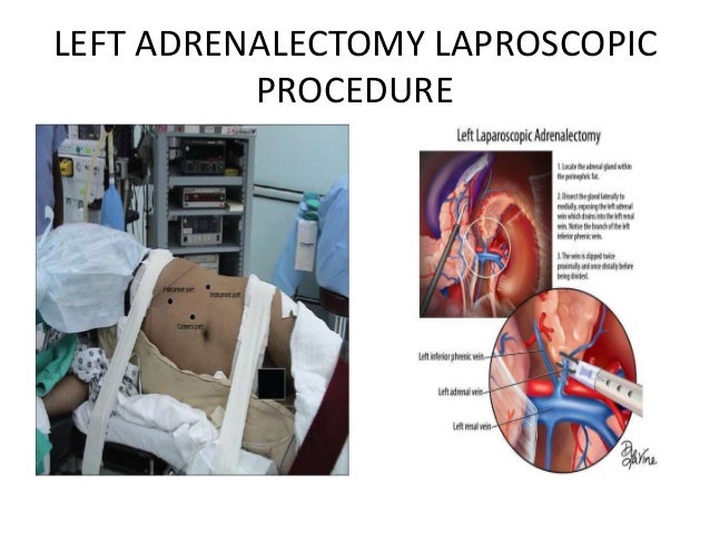Adrenalectomy new