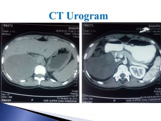 A 16 year old girl with right loin pain due to Adrenal ganglioneuroma.pptx