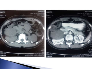 A 16 year old girl with right loin pain due to Adrenal ganglioneuroma.pptx