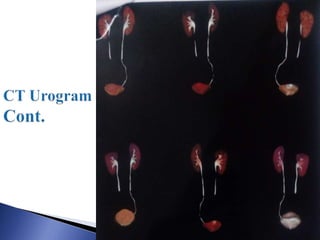 A 16 year old girl with right loin pain due to Adrenal ganglioneuroma.pptx