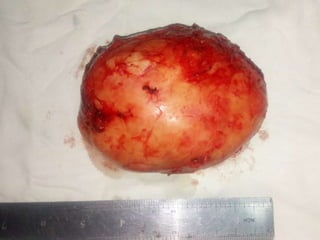 A 16 year old girl with right loin pain due to Adrenal ganglioneuroma.pptx
