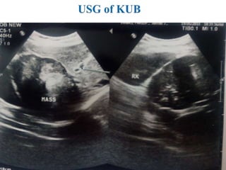 A 16 year old girl with right loin pain due to Adrenal ganglioneuroma.pptx