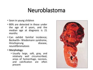 Adrenal gland diseases and tumors | PPTX