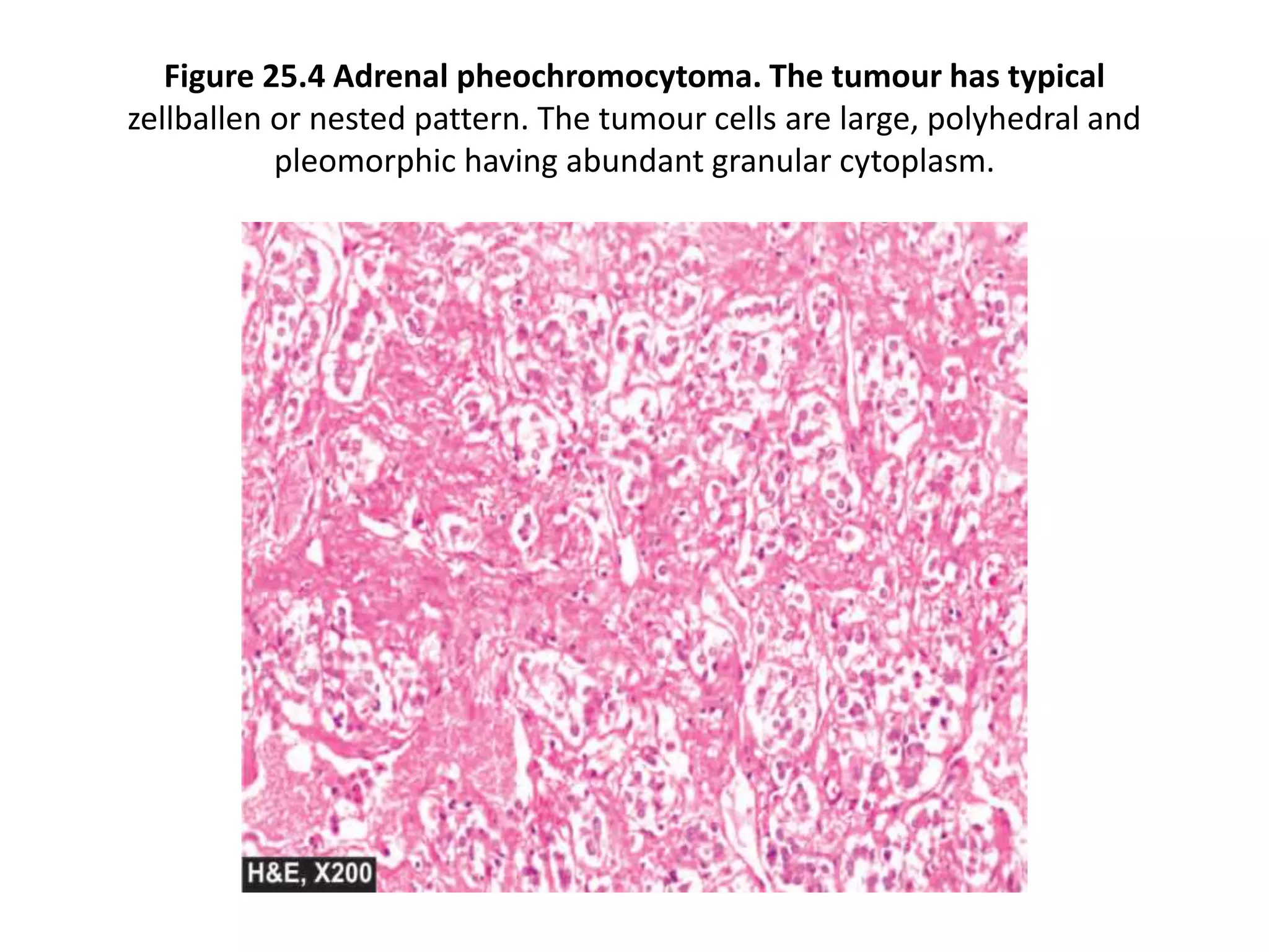 ADRENAL GLAND PATHOLOGY | PPTX