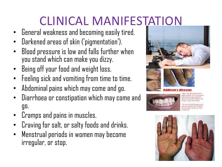 Enlarged Adrenal Gland Symptoms