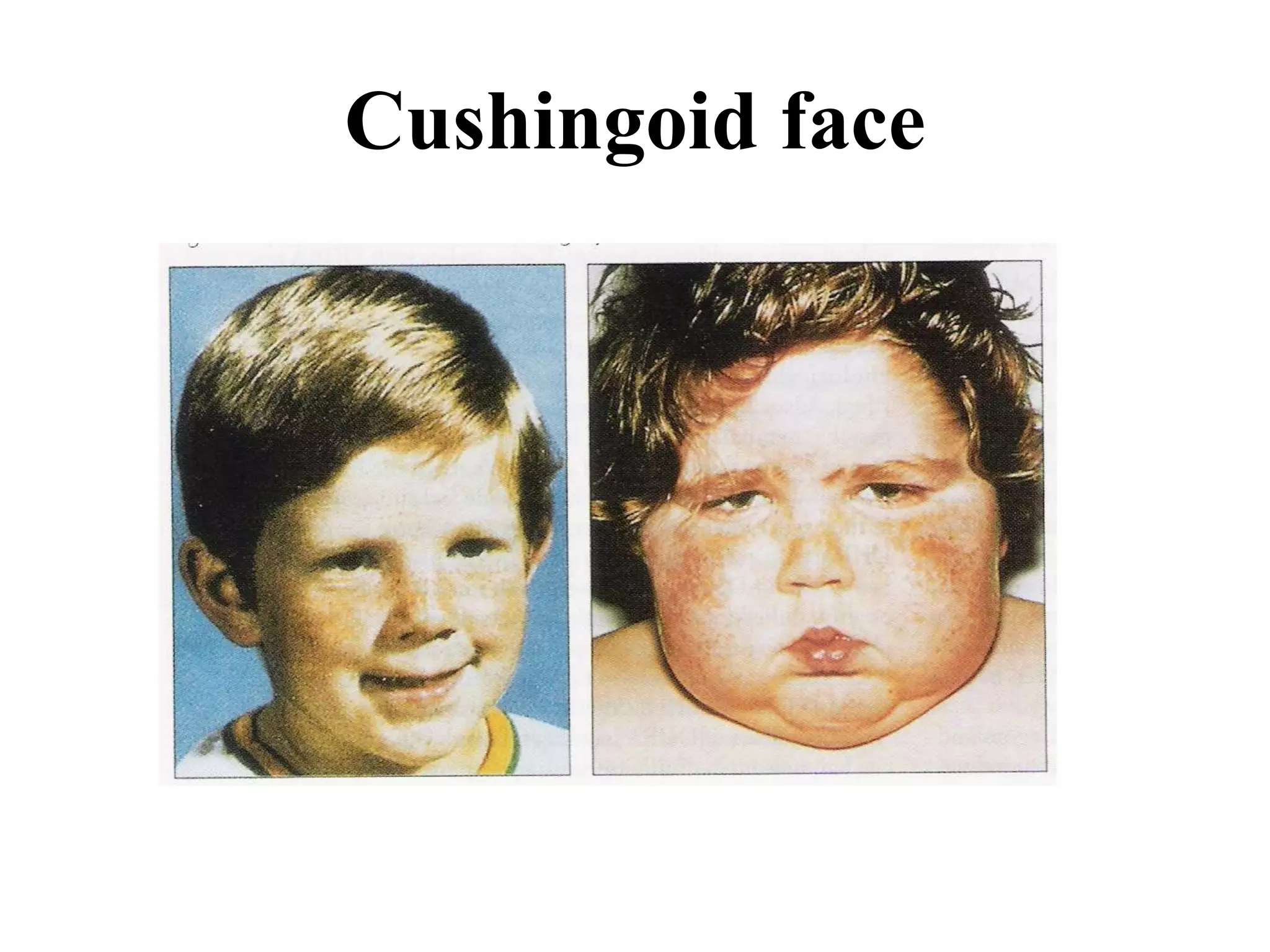 Adrenal gland disorders | PPT