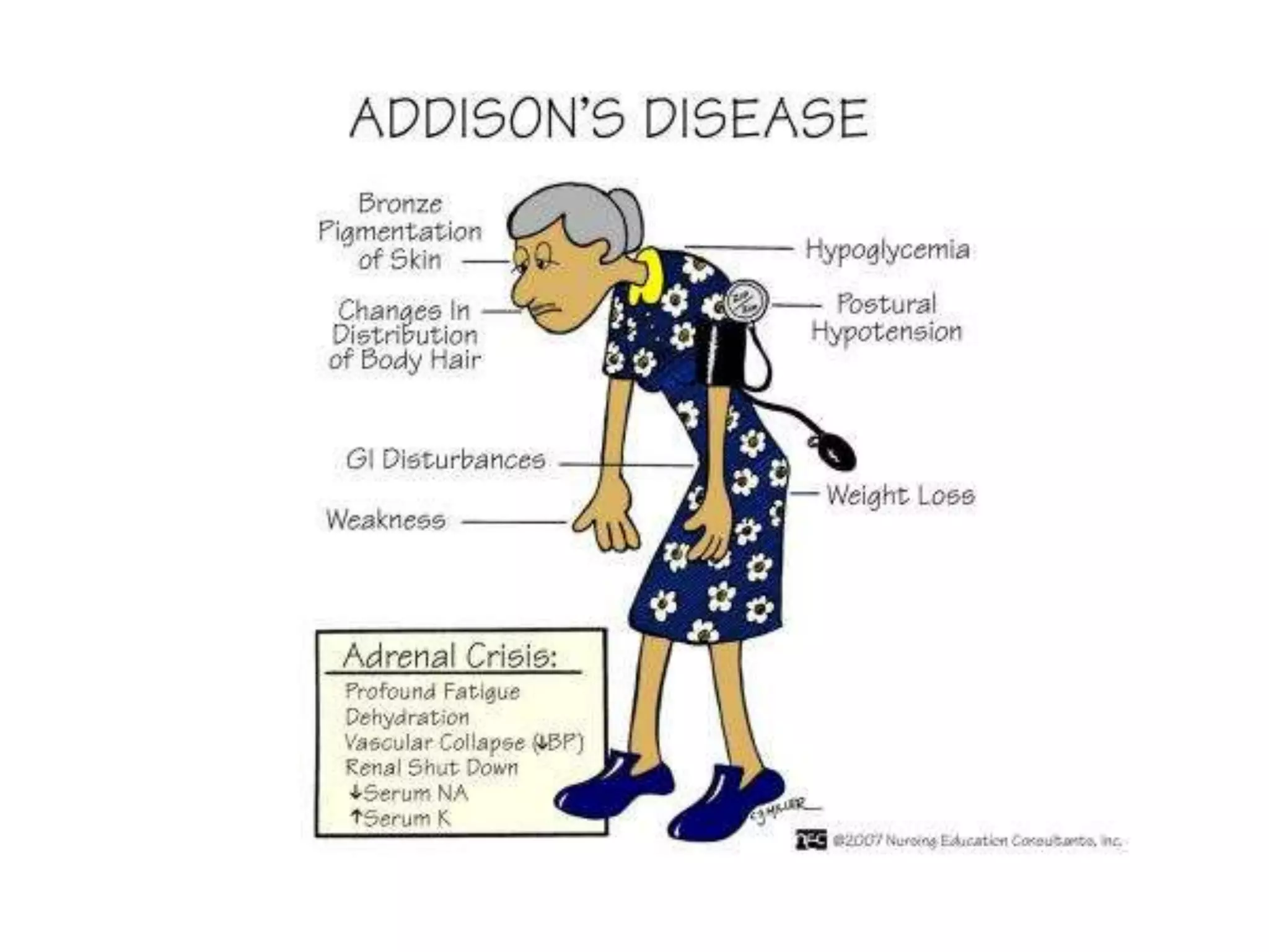 Adrenal Gland Disorders Ppt