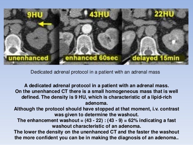 Adrenal gland tumors (Radiology)