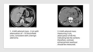 Overview of adrenal incidentaloma PPT- PPTX | PPTX