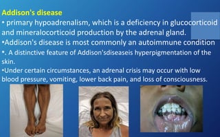 Adrenal insufficeincy/ADRENAL CRISIS | PPTX