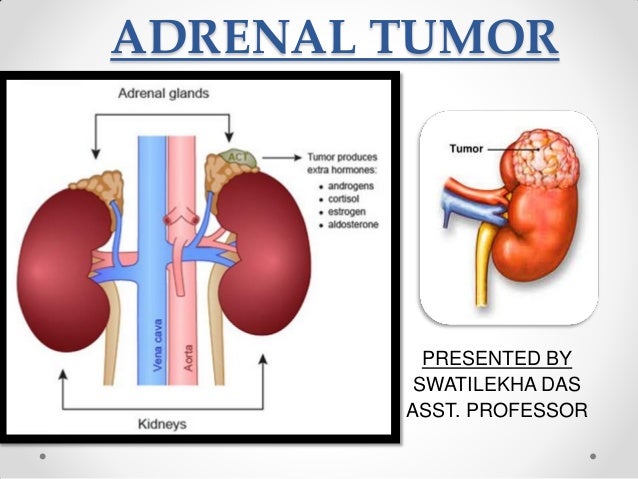 Adrenal Gland Tumor Symptoms