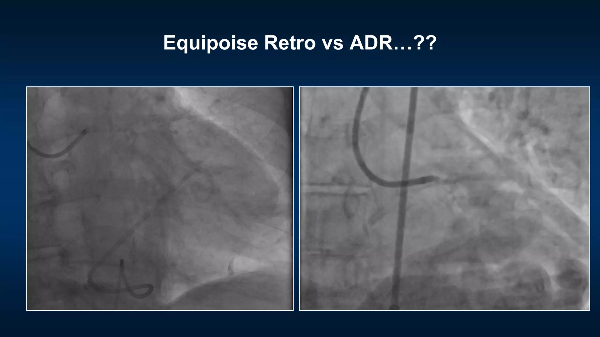 Where is the role for Antegrade dissection reentry? | PPT