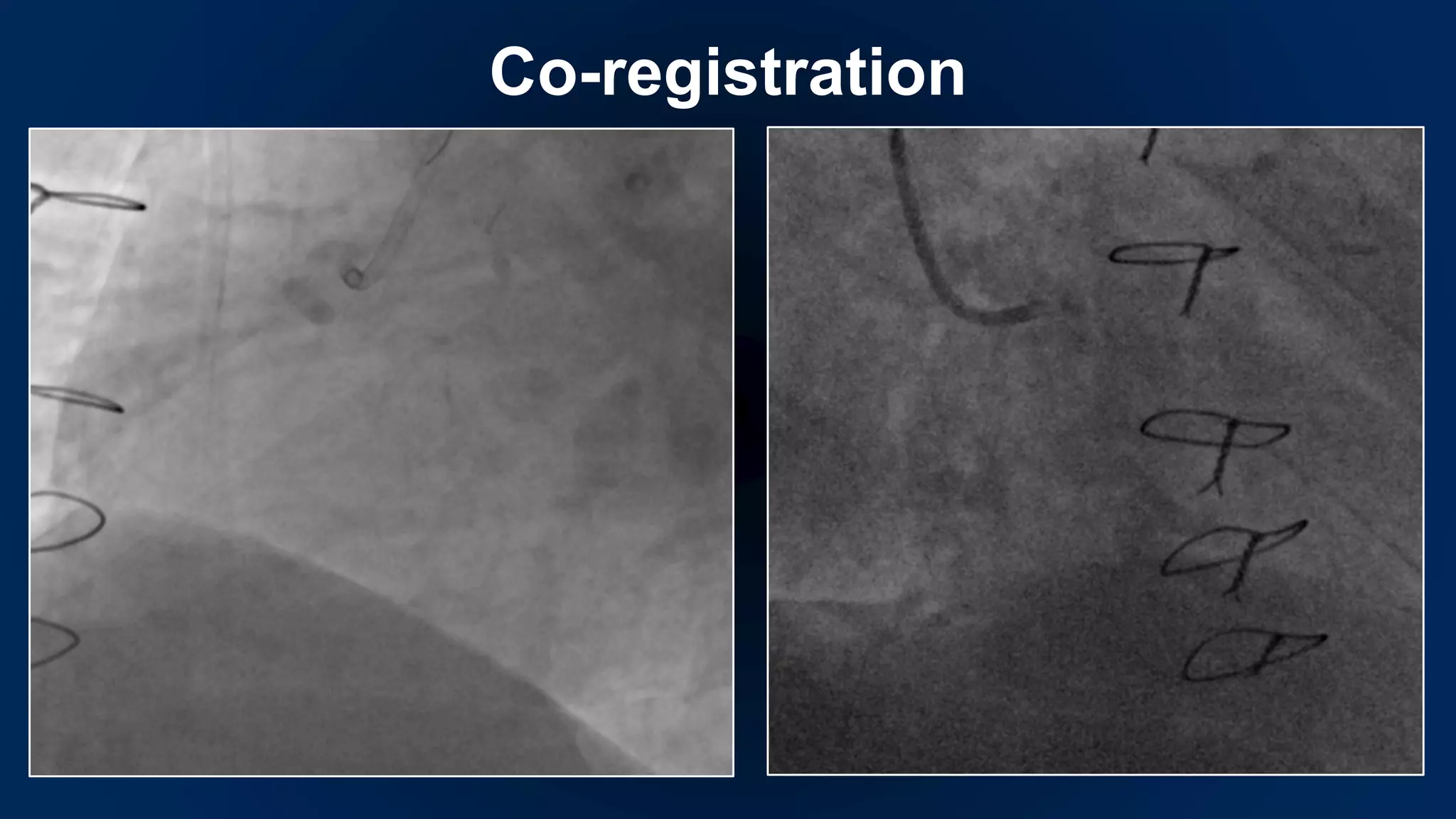 Where is the role for Antegrade dissection reentry? | PPT