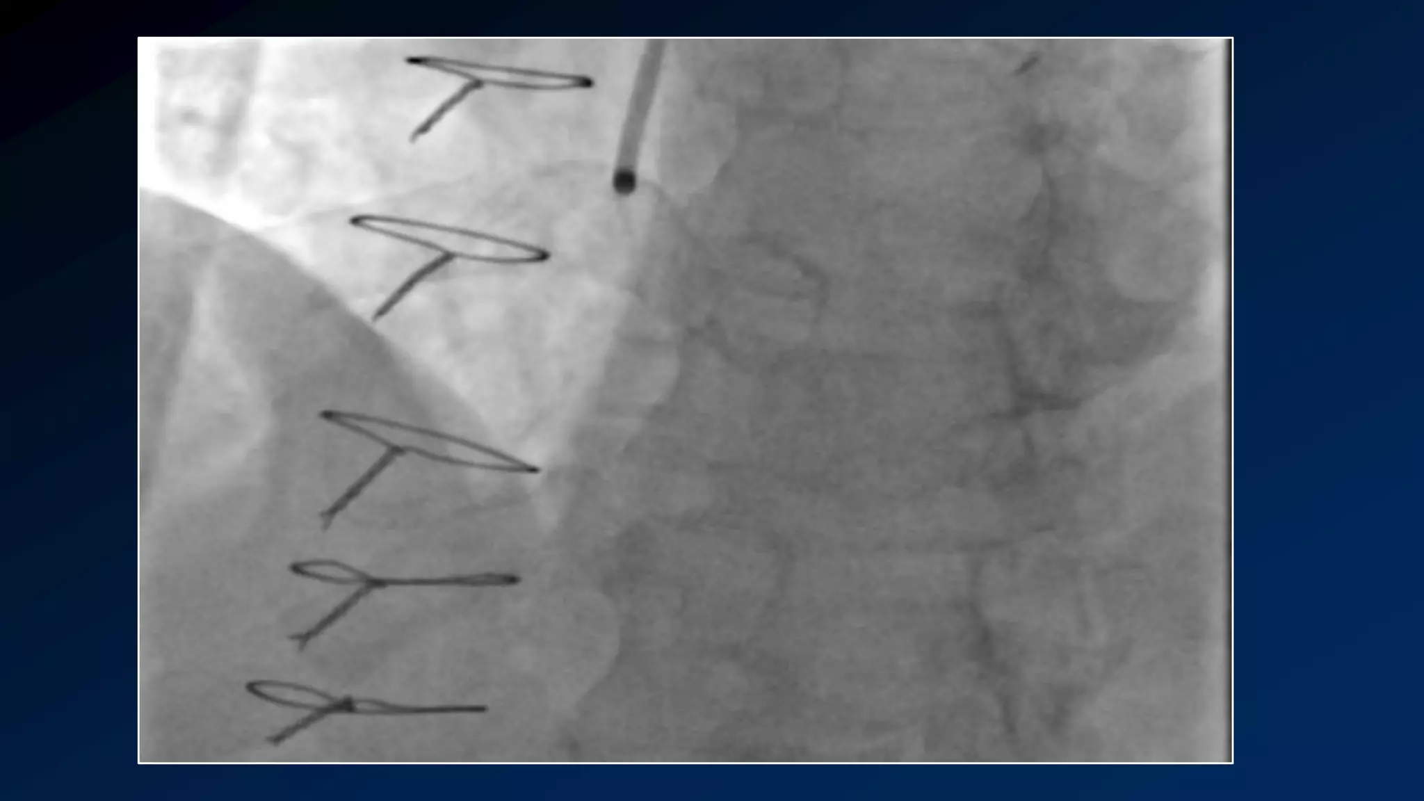 Where is the role for Antegrade dissection reentry? | PPT