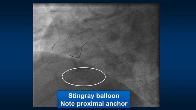 Where is the role for Antegrade dissection reentry? | PPT