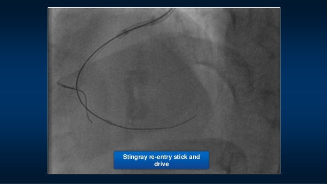 Where is the role for Antegrade dissection reentry?