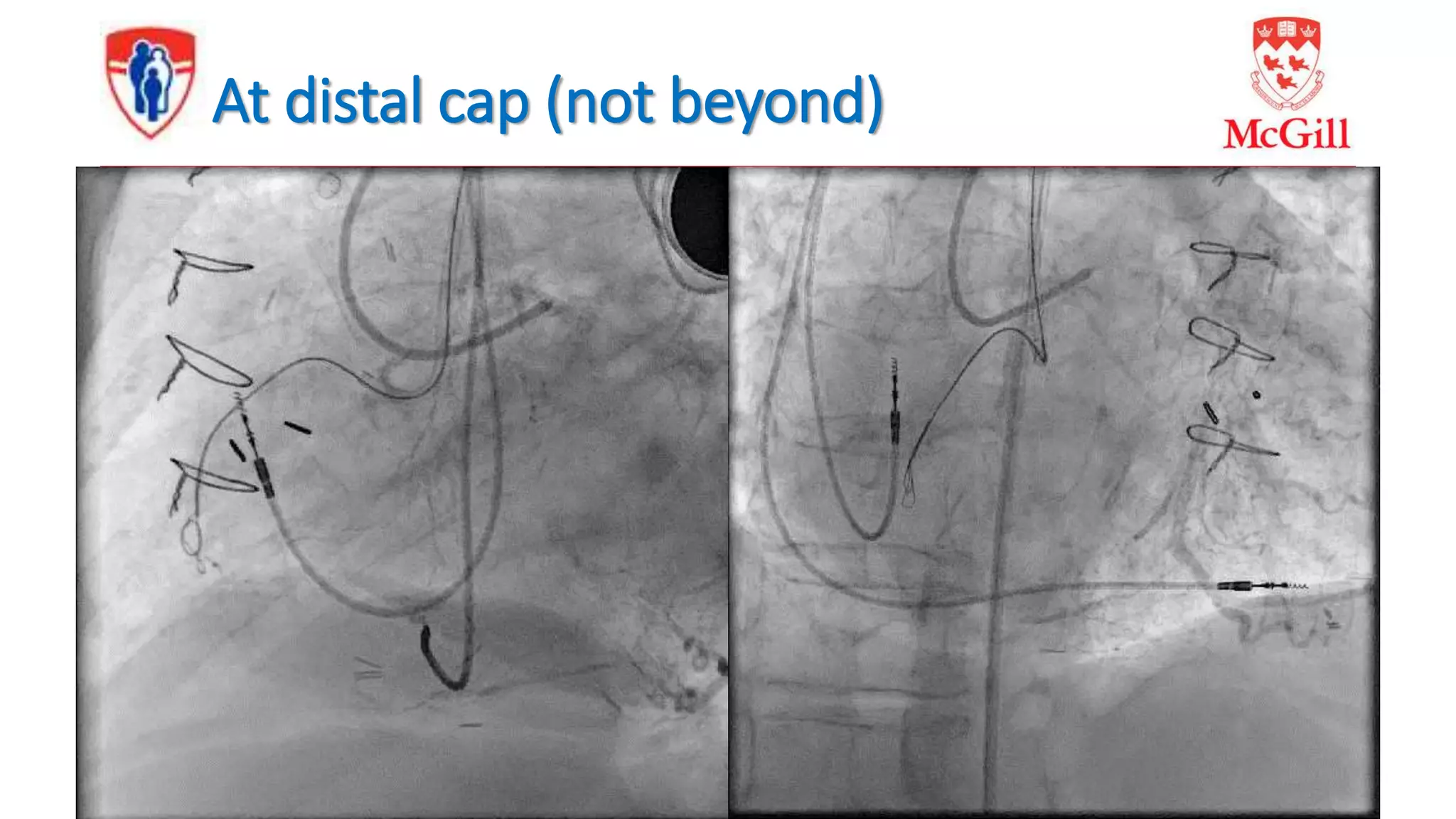 New developments in antegrade dissection/re-entry approach | PPTX