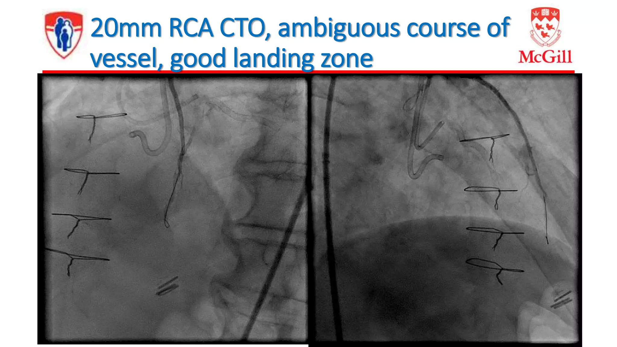 New developments in antegrade dissection/re-entry approach | PPT