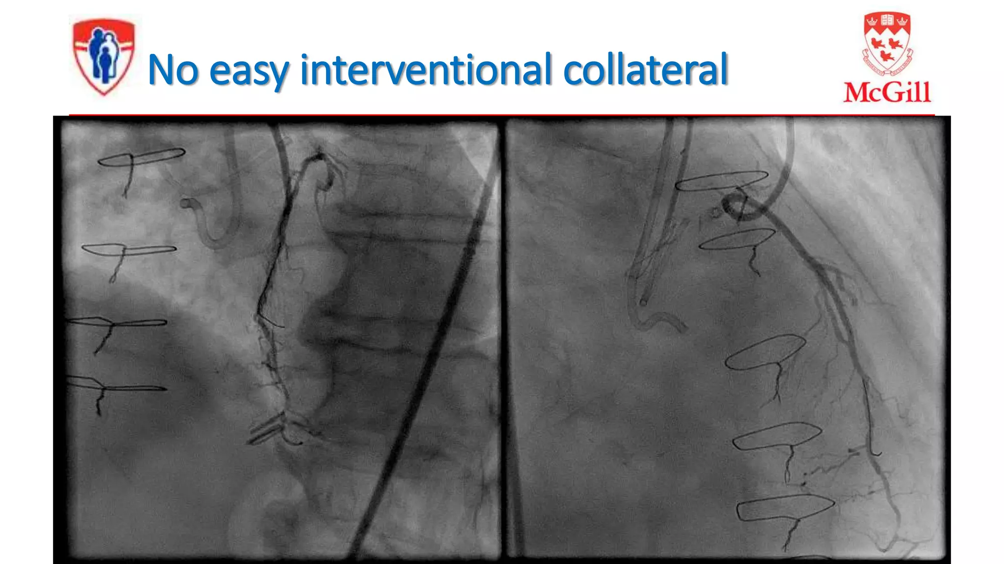 New developments in antegrade dissection/re-entry approach | PPT