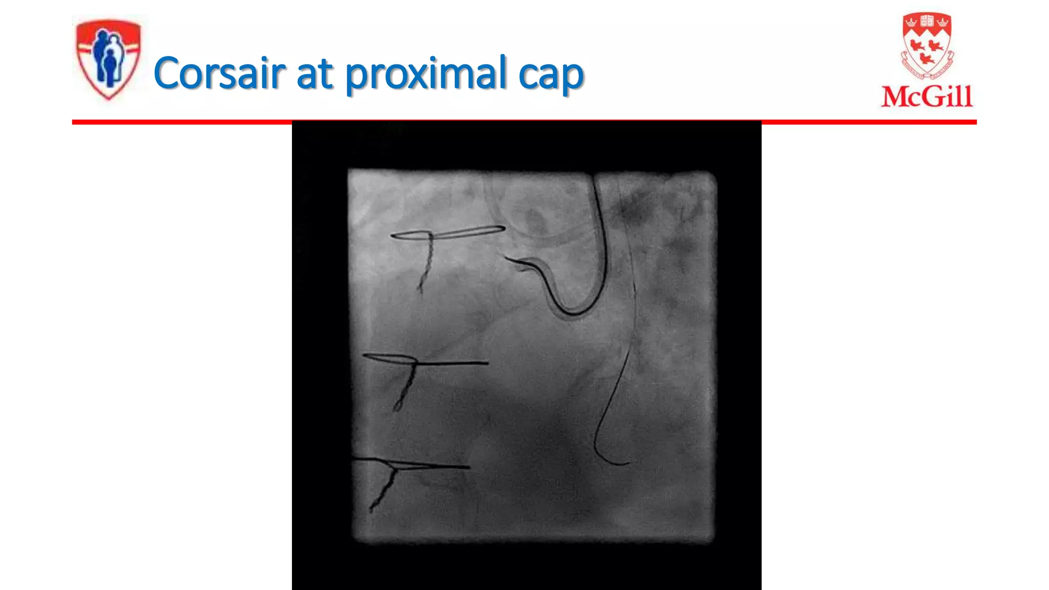 New developments in antegrade dissection/re-entry approach | PPT