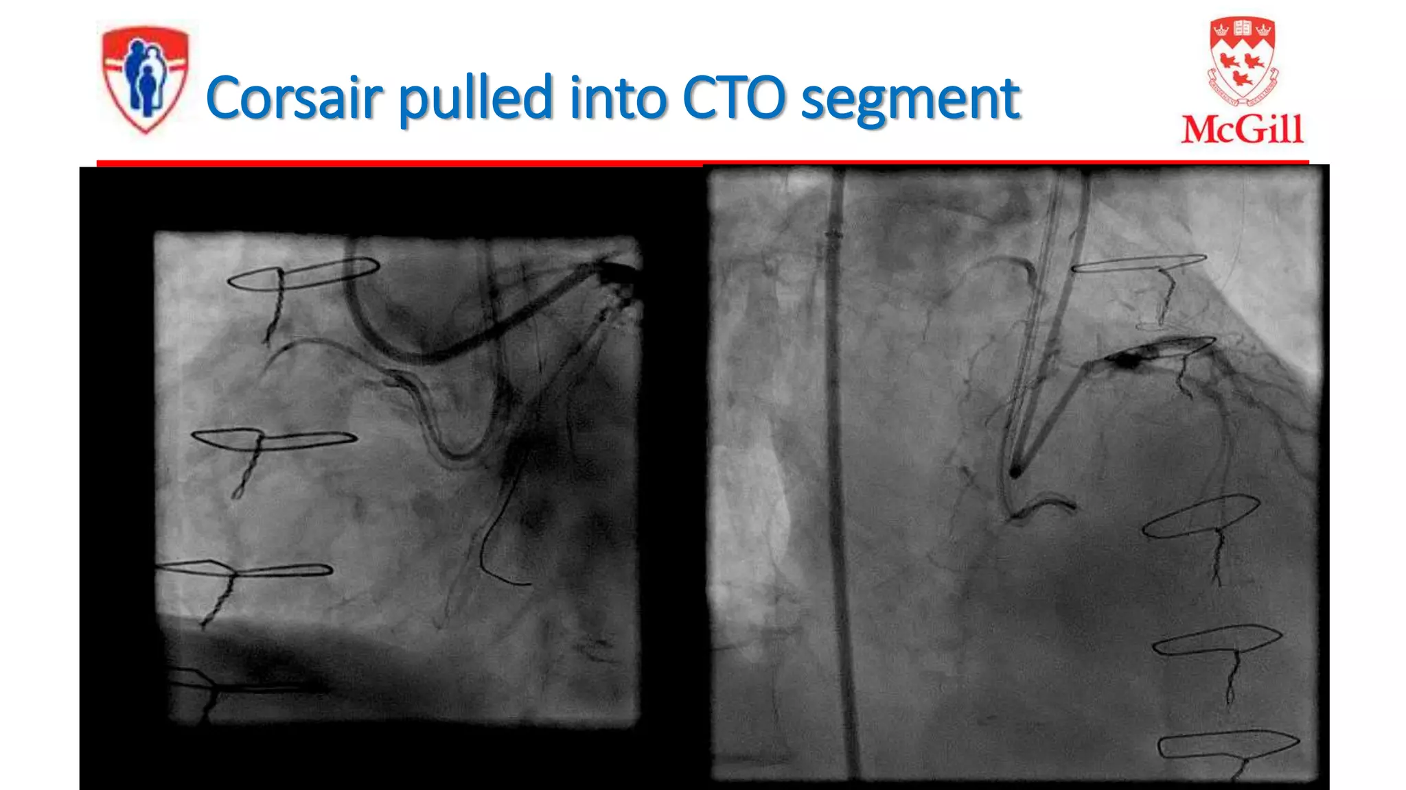 New developments in antegrade dissection/re-entry approach | PPT