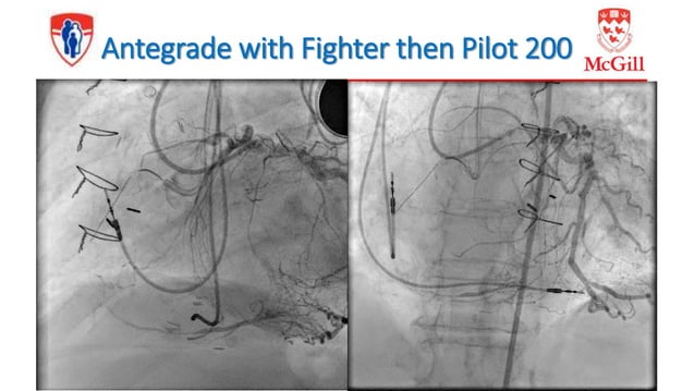 New developments in antegrade dissection/re-entry approach | PPT