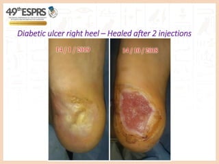 Efficacy of adipose derived stem cells in management of chronic ulcers ...