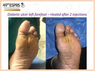 Efficacy of adipose derived stem cells in management of chronic ulcers ...