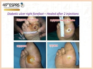Efficacy of adipose derived stem cells in management of chronic ulcers ...