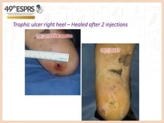 Efficacy of adipose derived stem cells in management of chronic ulcers ...