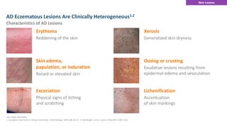 SA algorithm for eczema treatment Final | PPTX