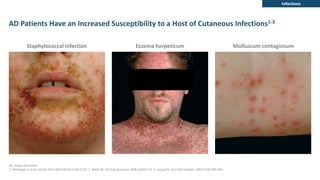 SA algorithm for eczema treatment Final | PPTX