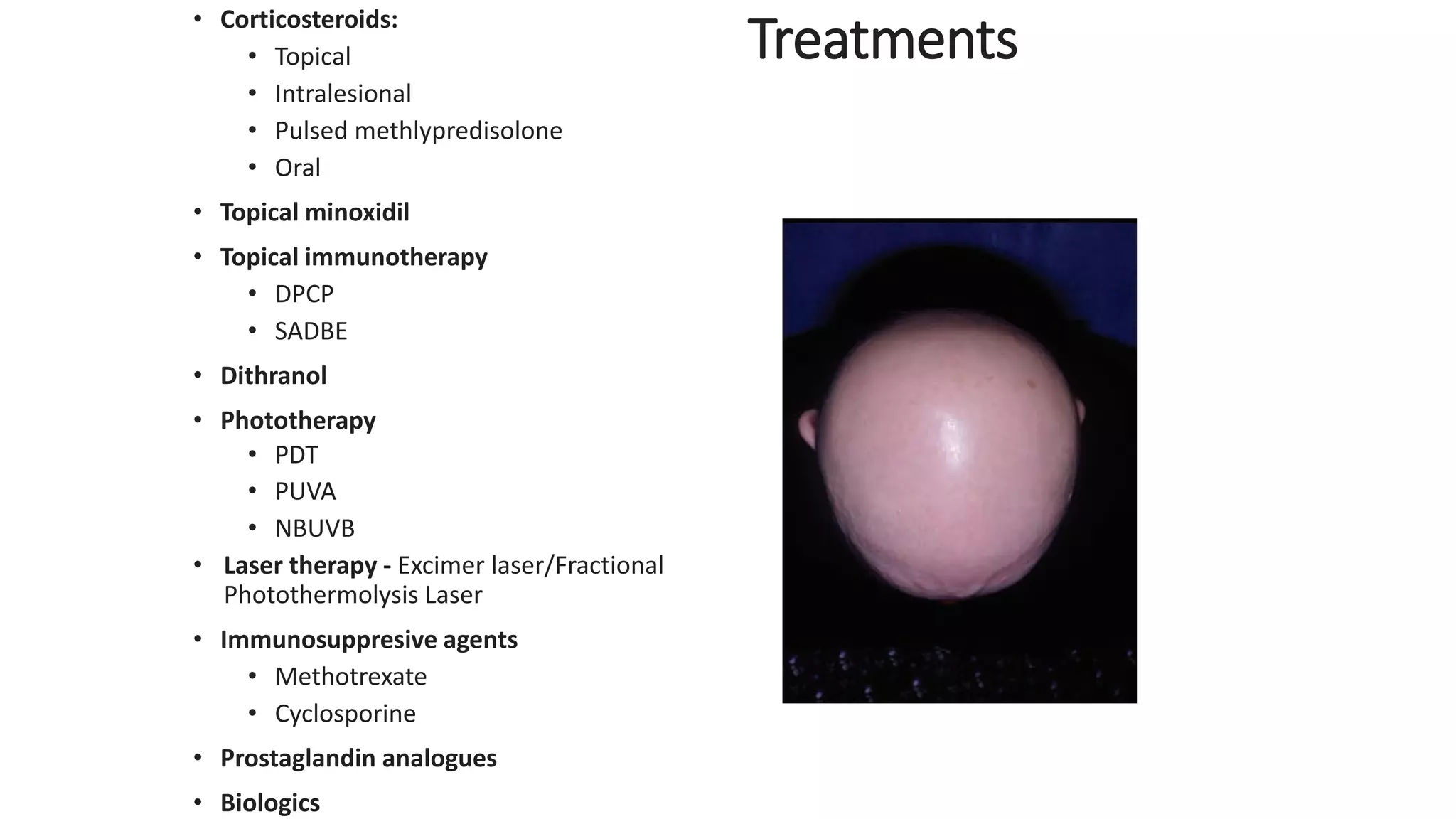Treatment of Alopecia Areata: Overview | PDF