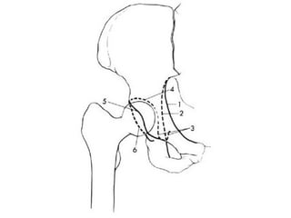 adult-acetabular-fracture pelvic ring fracture | PPT