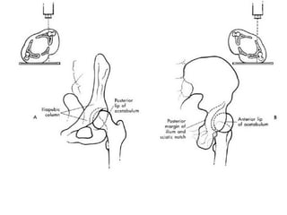 adult-acetabular-fracture pelvic ring fracture | PPT