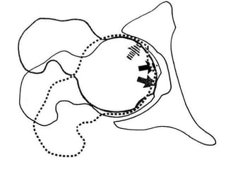 adult-acetabular-fracture pelvic ring fracture | PPT