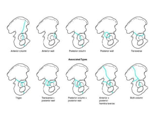 adult-acetabular-fracture pelvic ring fracture | PPT