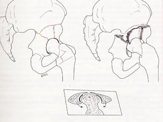 adult-acetabular-fracture pelvic ring fracture | PPT