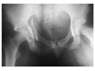 adult-acetabular-fracture pelvic ring fracture | PPT