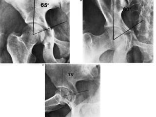 adult-acetabular-fracture pelvic ring fracture | PPT