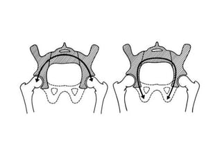 adult-acetabular-fracture pelvic ring fracture | PPT