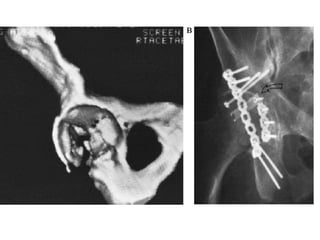 adult-acetabular-fracture pelvic ring fracture | PPT