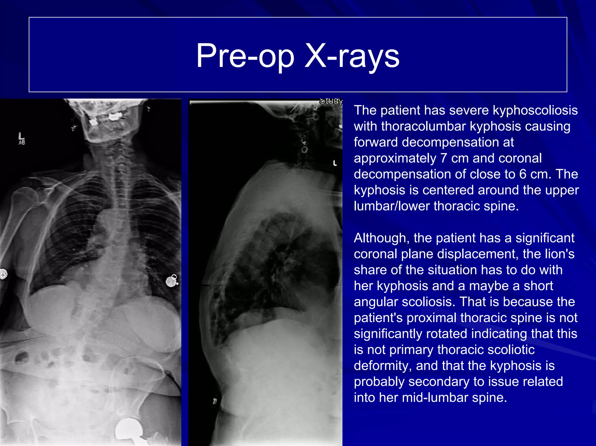 Case Review #26: 73 year old female with Kyphoscoliosis | PDF