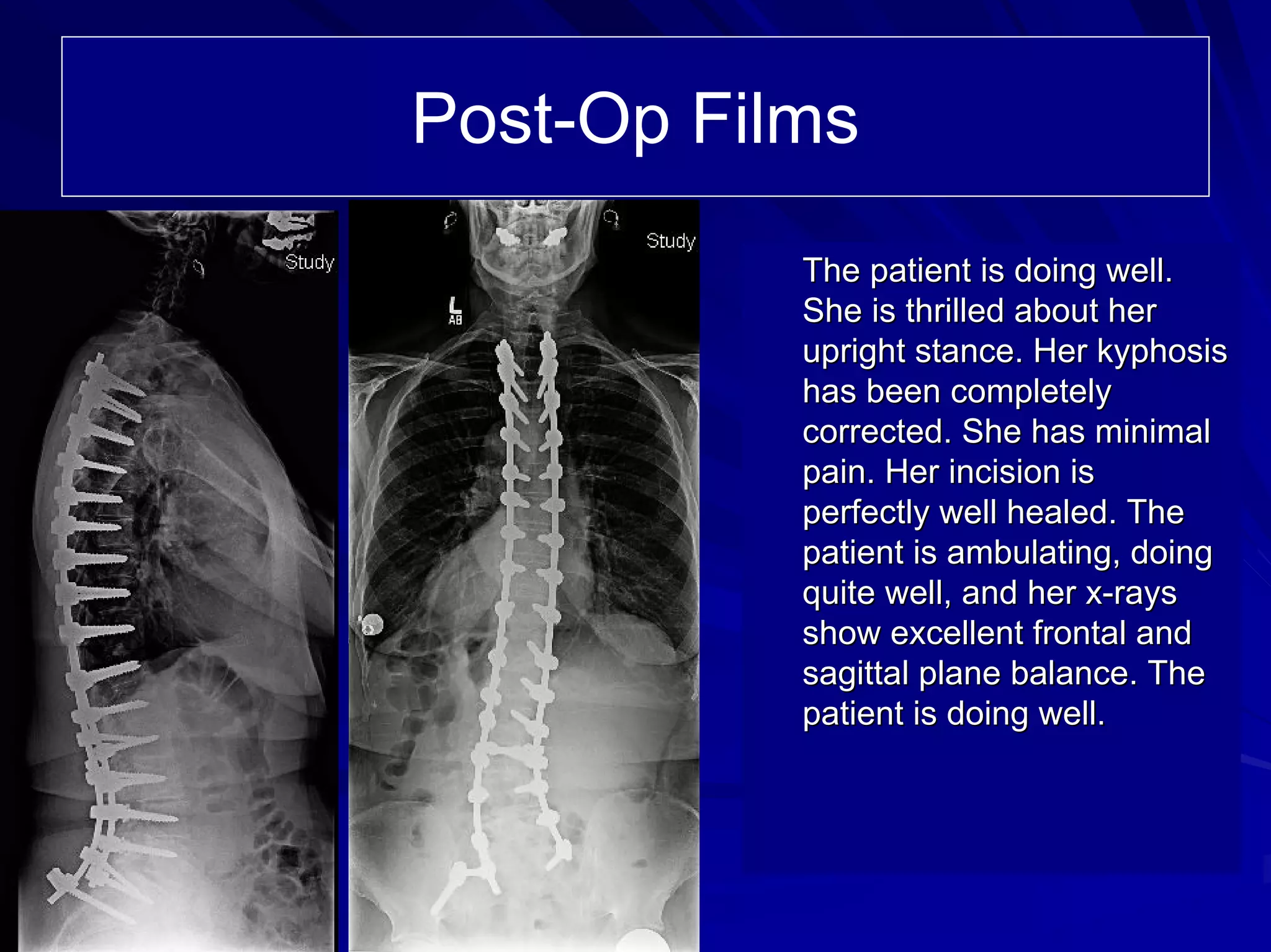 Case Review #26: 73 year old female with Kyphoscoliosis | PDF