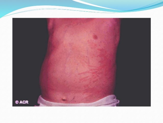 Adult onset-still-disease-1