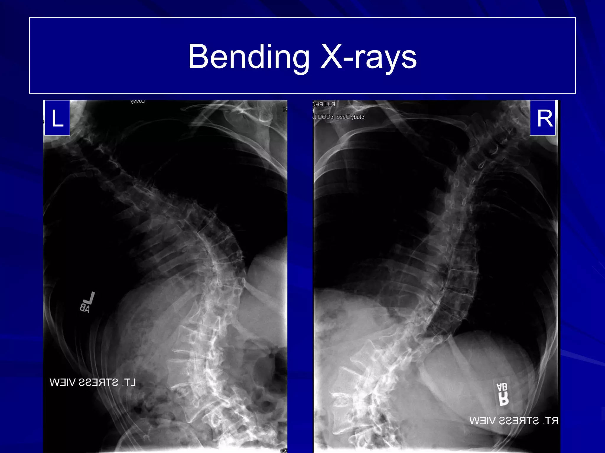 Case Review #6: 53 year old woman with Adult Scoliosis | PDF