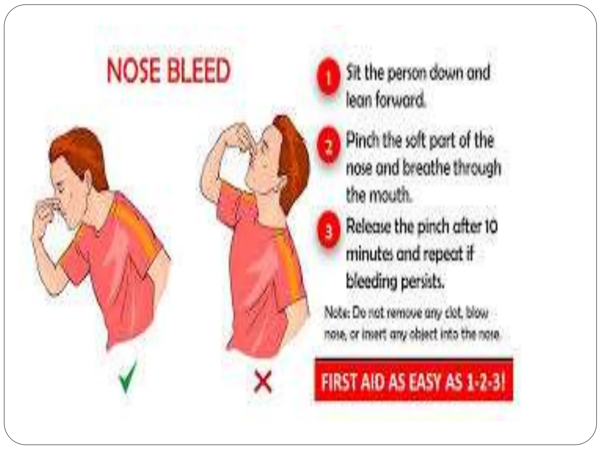 Adult epistaxis Etiology and management .pptx